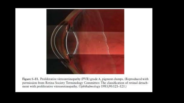 Tractional RD | PPTX