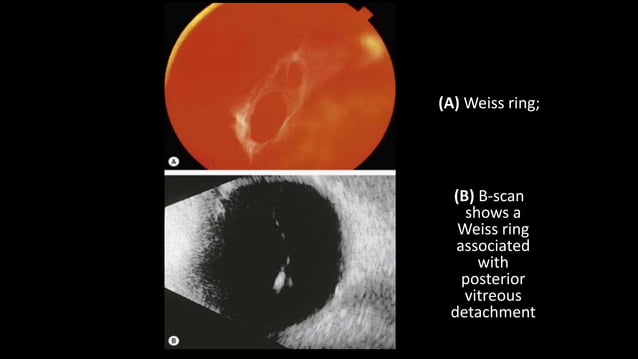 Tractional RD | PPTX