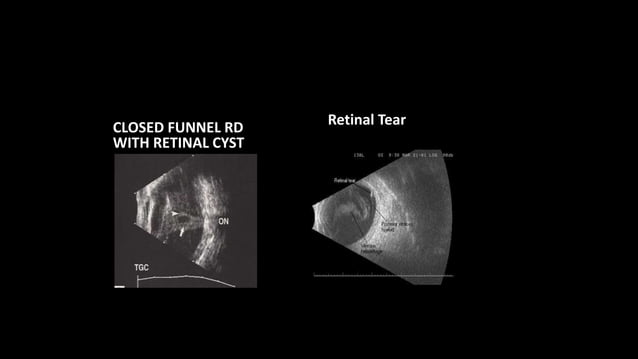 Tractional RD | PPTX