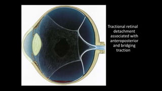 Tractional Retinal Detachment