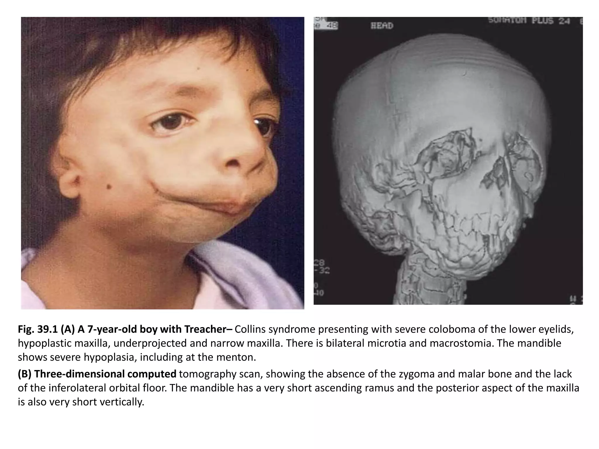 Treacher colllin syndrome | PPTX