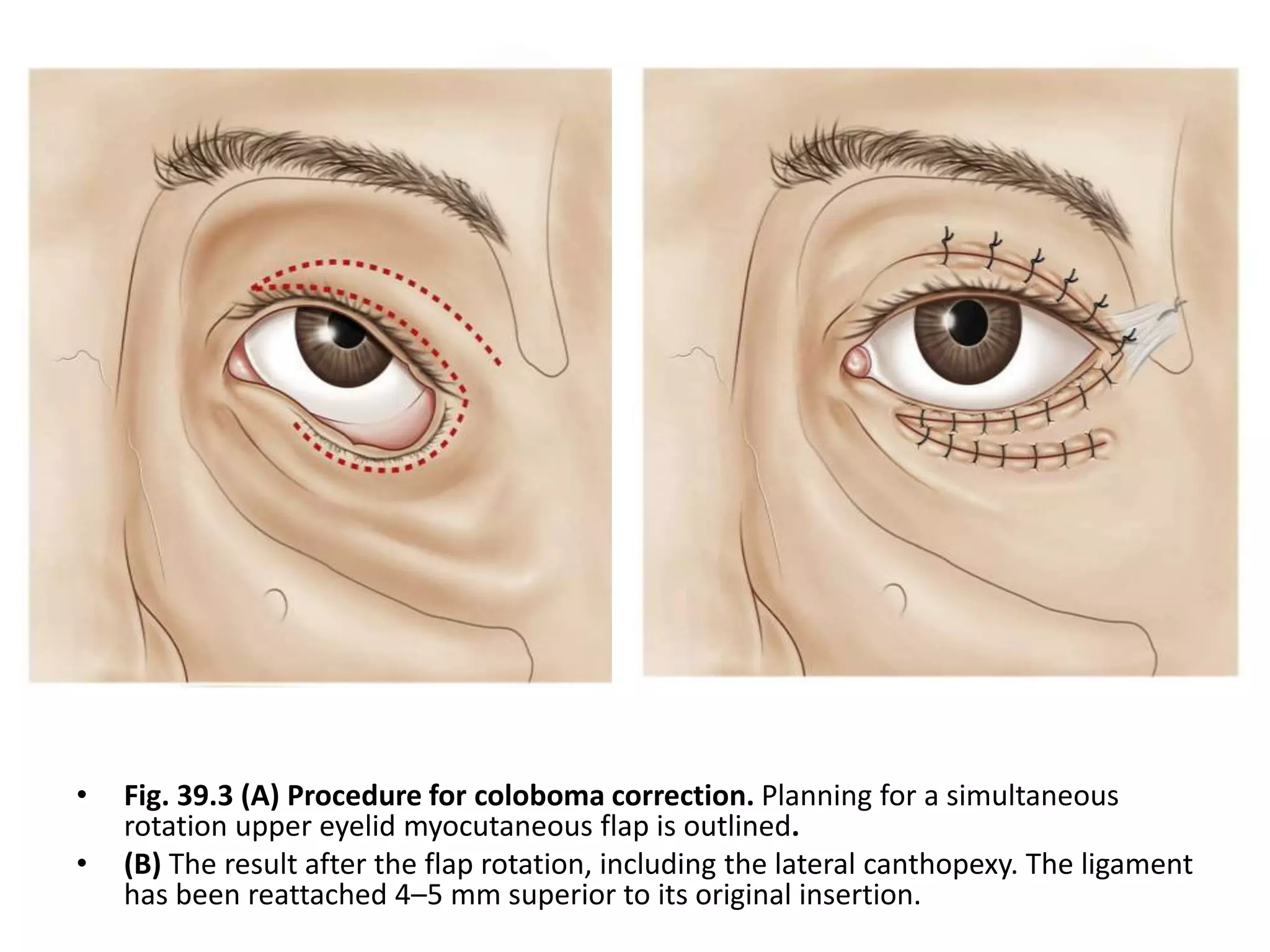 Treacher colllin syndrome | PPTX
