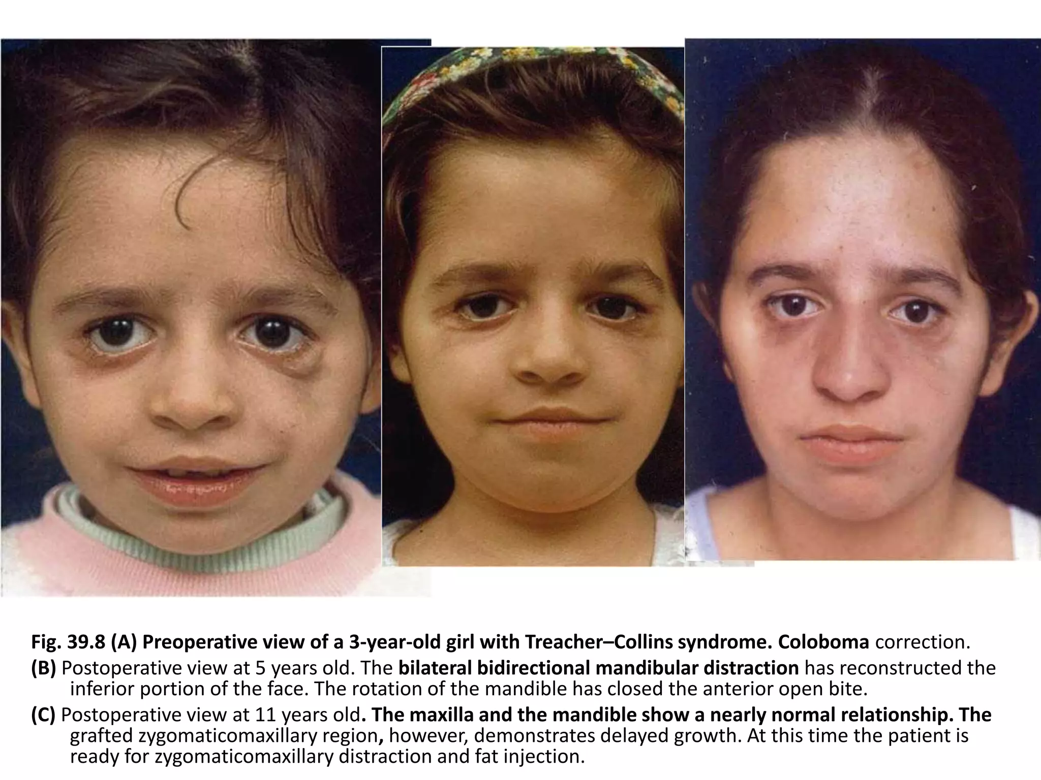 Treacher colllin syndrome | PPTX