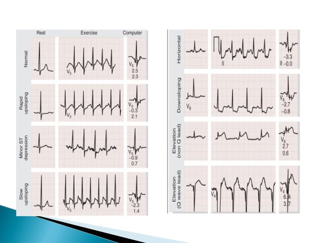 Treadmill test (TMT) | PPT