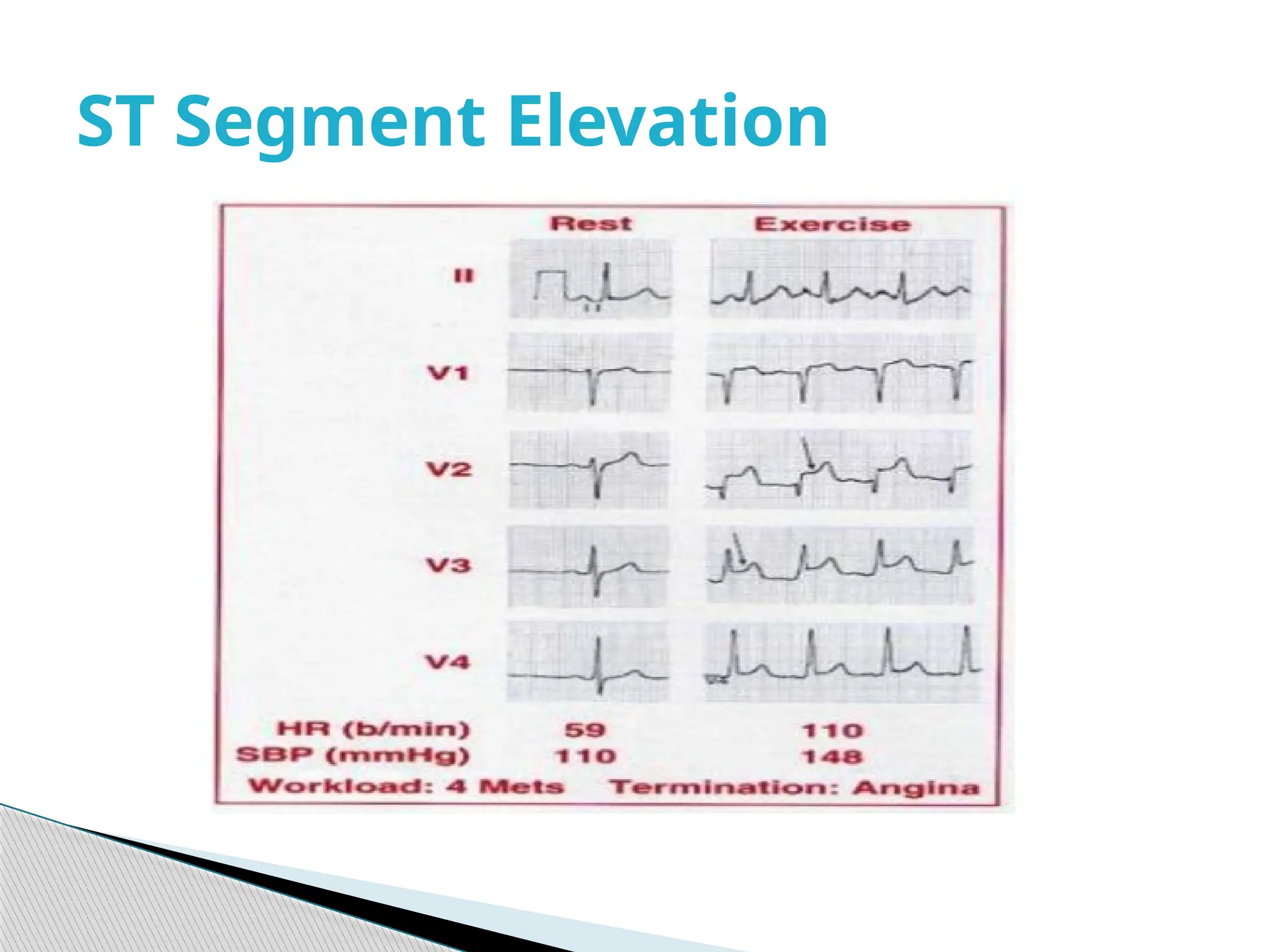 Treadmill (TMT) or treadmill exercise test | PPT