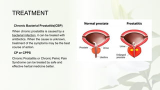Treat chronic prostatitis by herbal medicine | PDF