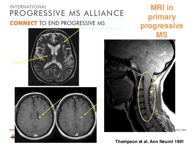 Treatement in progressive MS