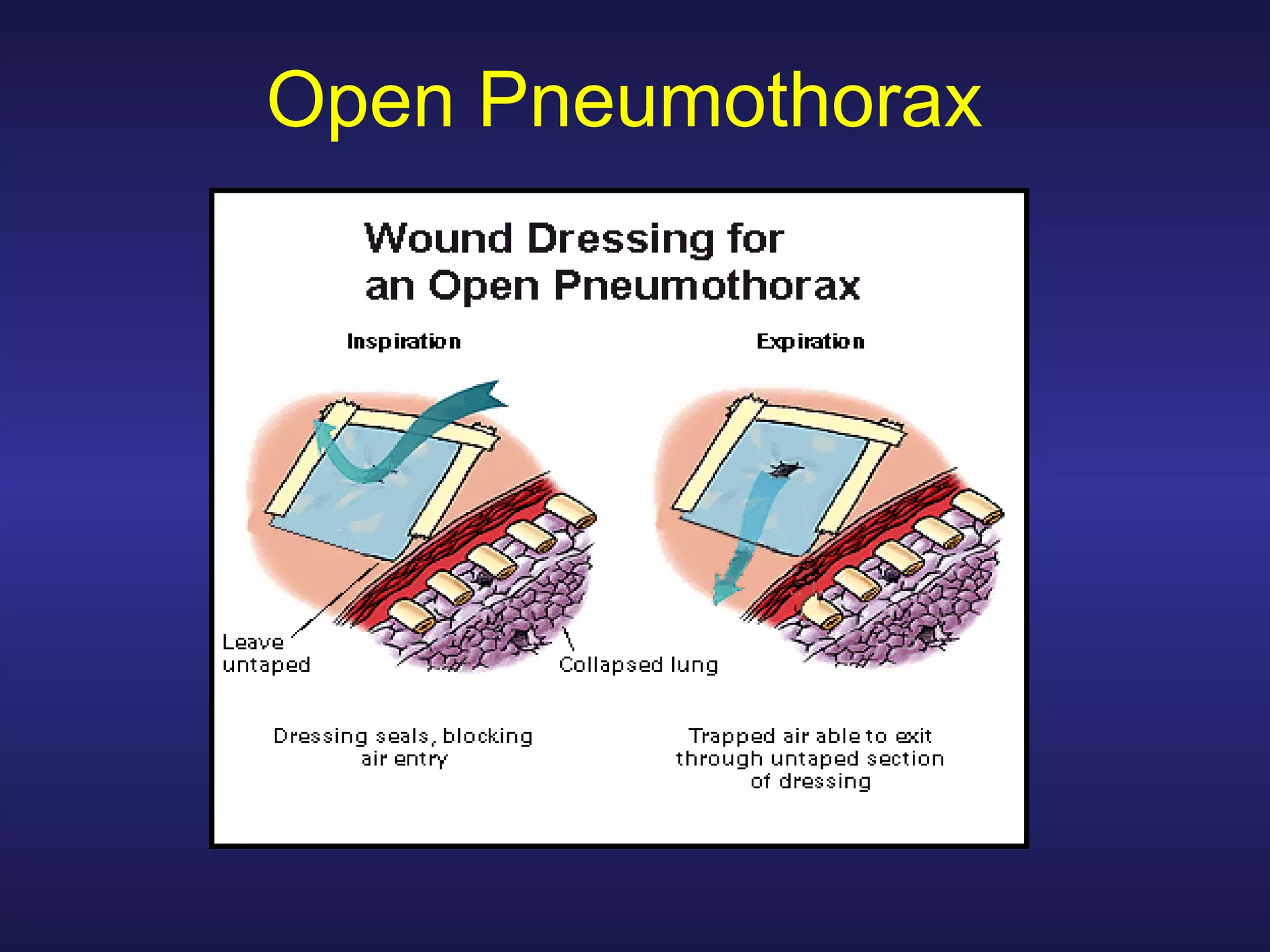 Treating Penetrating Chest Trauma | PPT