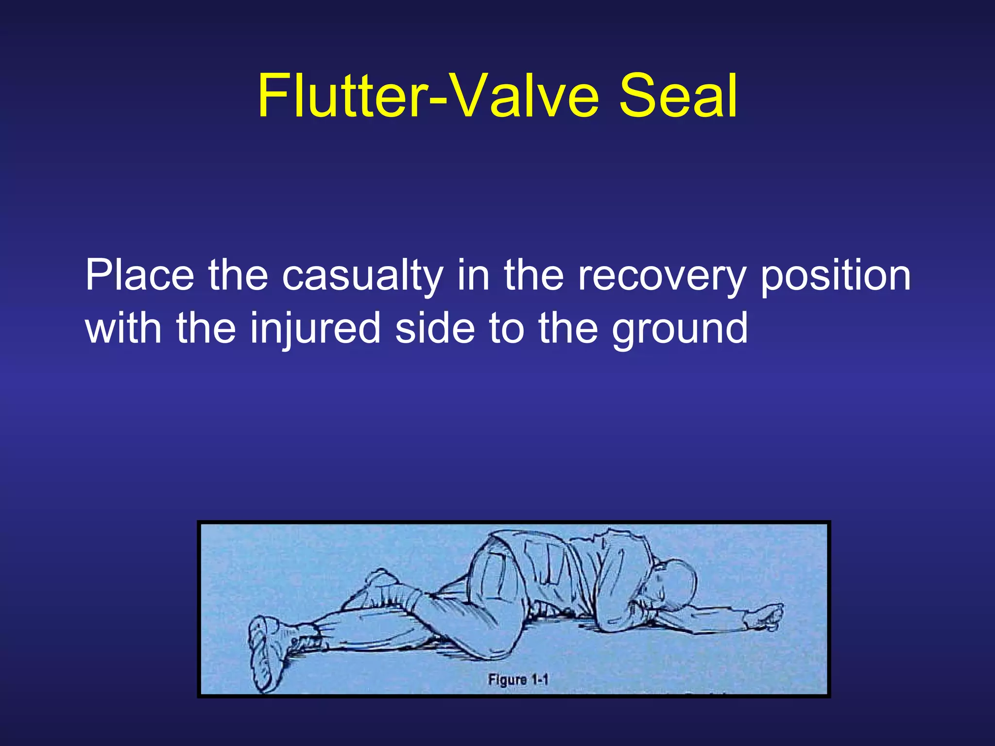 Treating Penetrating Chest Trauma | PPT