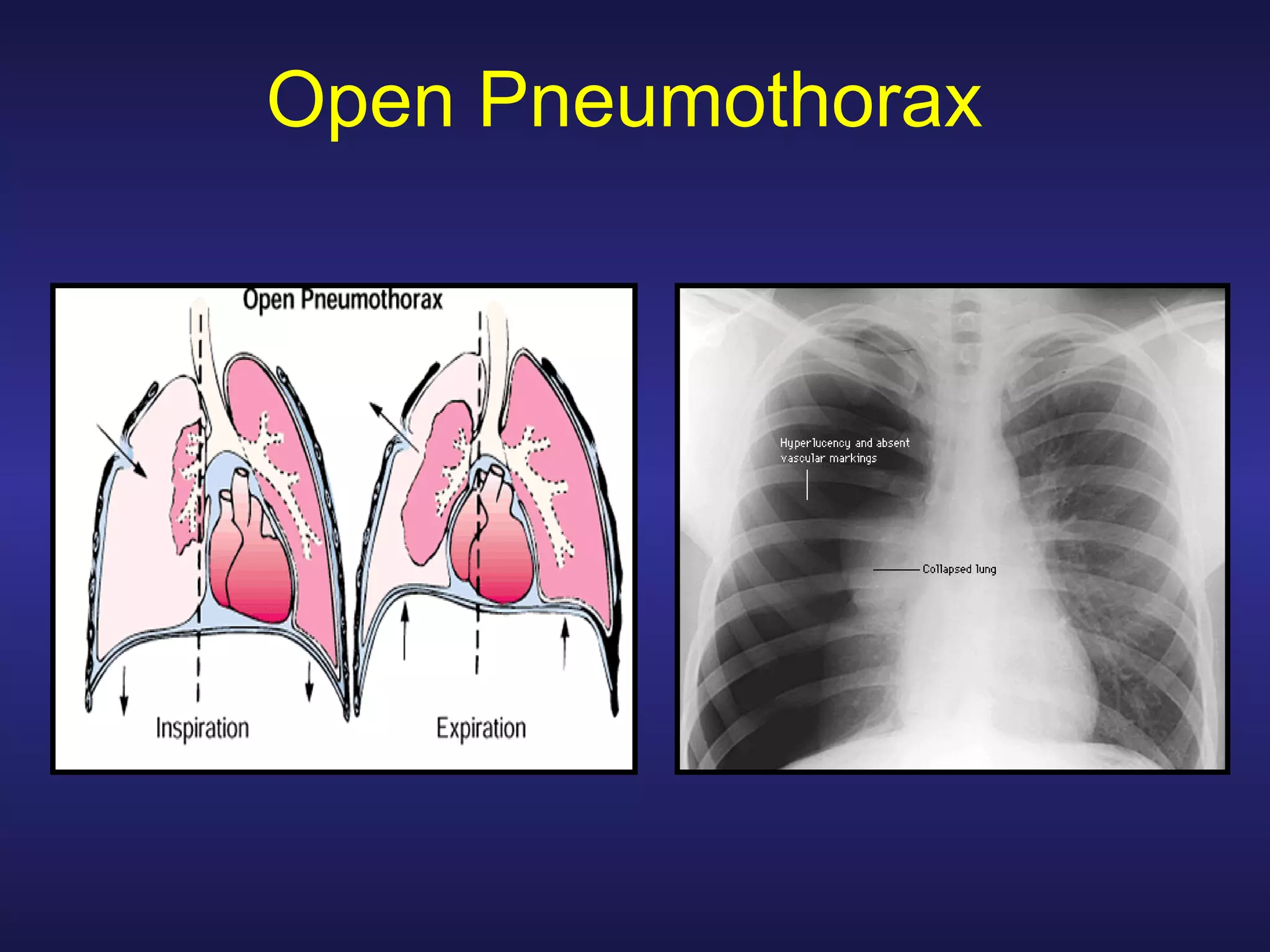Treating Penetrating Chest Trauma | PPT