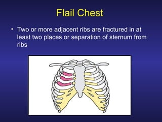 Treating Penetrating Chest Trauma | PPT