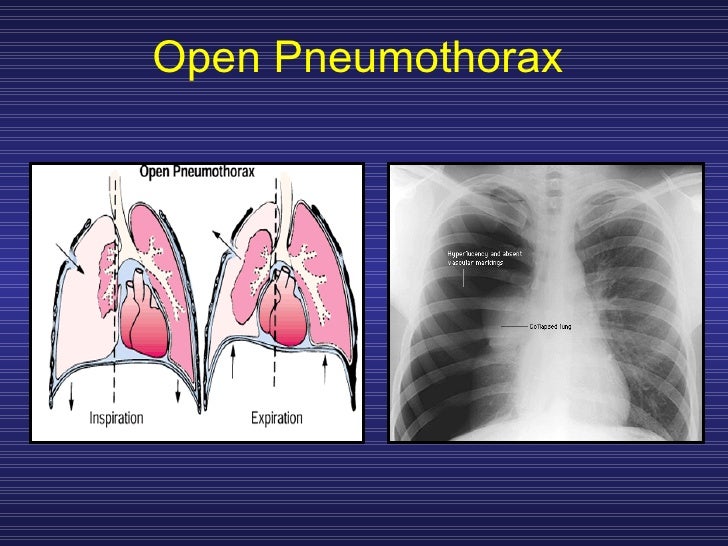 Treating Penetrating Chest Trauma