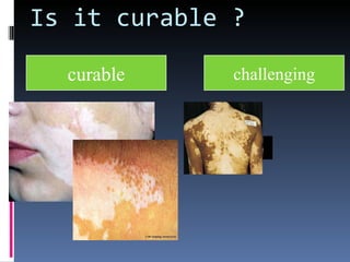 Treat leukoderma | PPT | Skin and Dermatology | Diseases and Conditions