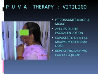 Treat leukoderma | PPT