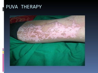 Treat leukoderma | PPT