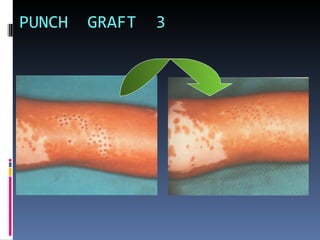 Treat leukoderma | PPT
