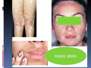 Treat leukoderma | PPT | Skin and Dermatology | Diseases and Conditions