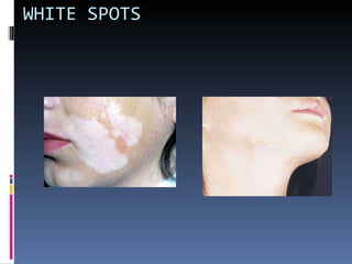 Treat leukoderma | PPT | Skin and Dermatology | Diseases and Conditions
