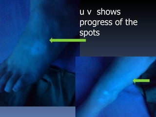 Treat leukoderma | PPT | Skin and Dermatology | Diseases and Conditions