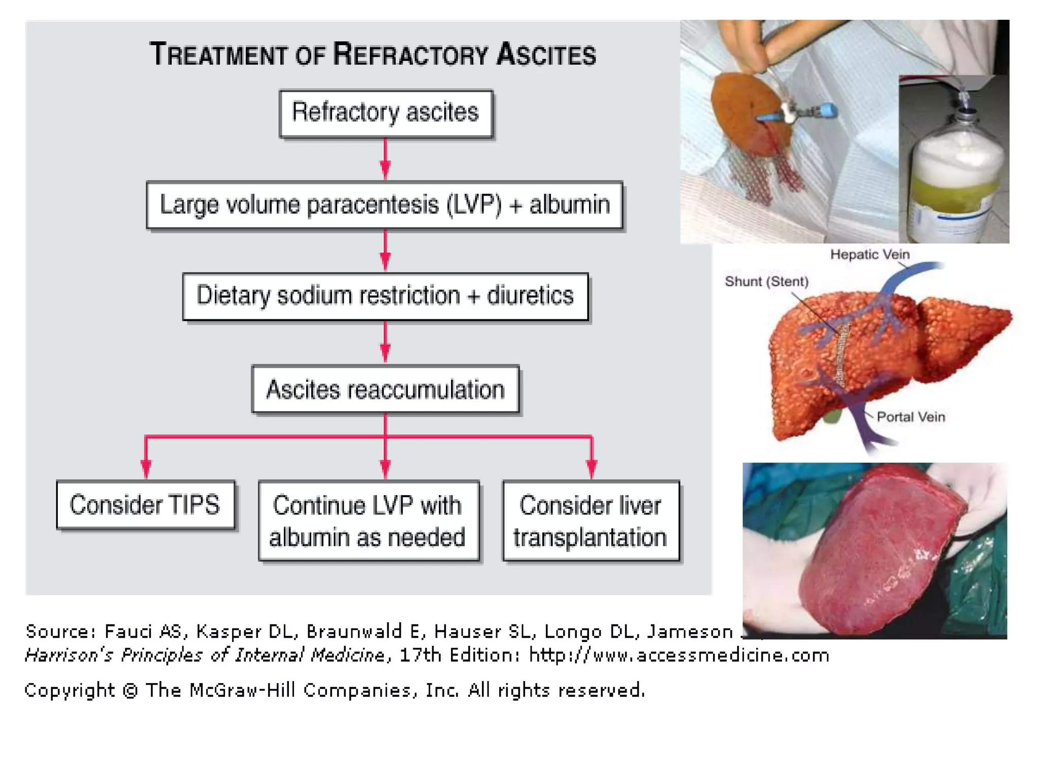 Treatment of refractory ascites | PPTX