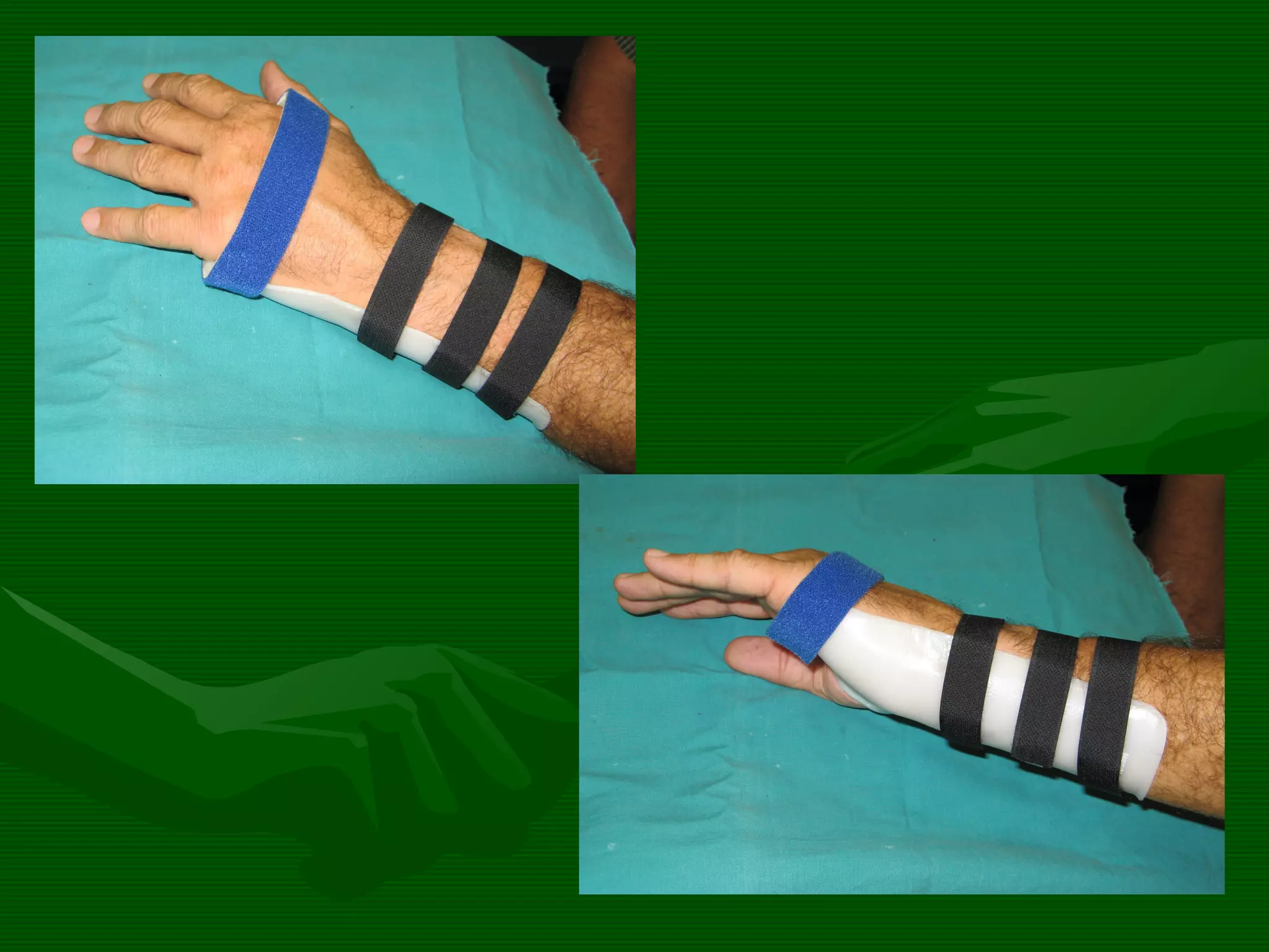 Hand Therapy - Treatment Modalities Of The Wrist | PPT