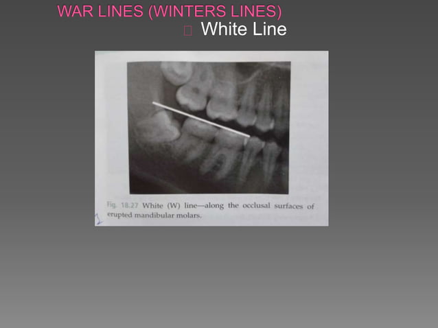 Treatment and complications of impactions | PPTX | Dental Health ...