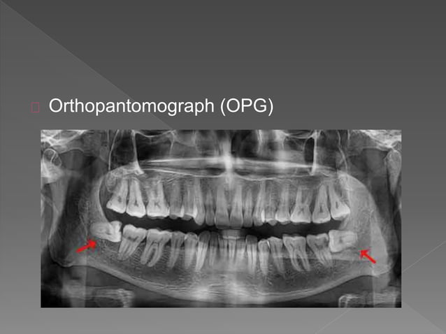 Treatment and complications of impactions | PPTX | Dental Health ...
