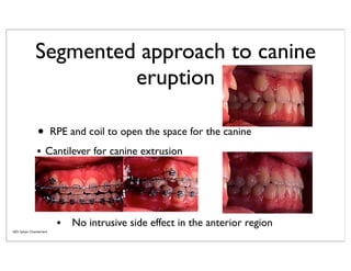 Treatment and management of impacted canine with speed appliance | PDF