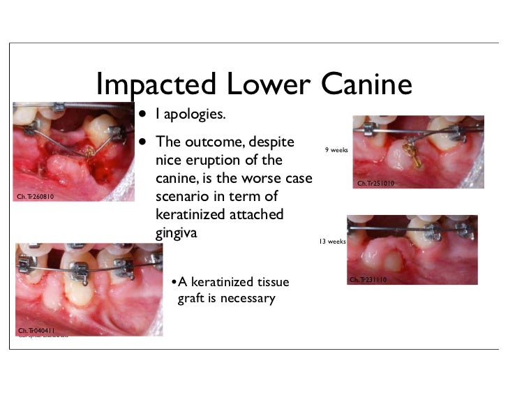 Treatment and management of impacted canine with speed appliance