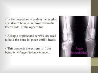 Treatment And Management of OA (1).pptx