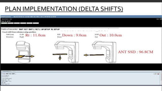 Treatment & challenges of uh breast radiotherapy | PPT