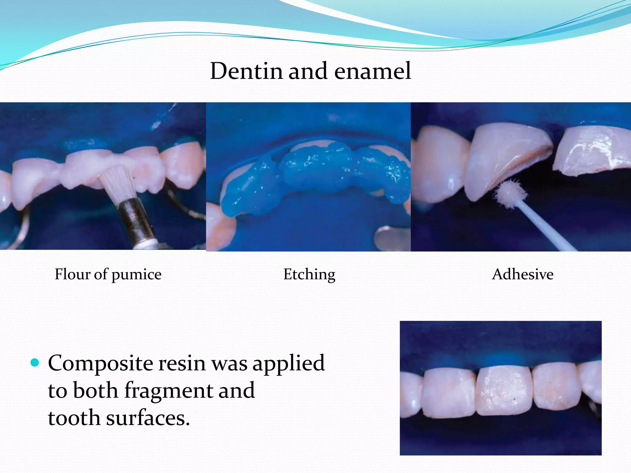 Treatment crown fracture | PPTX