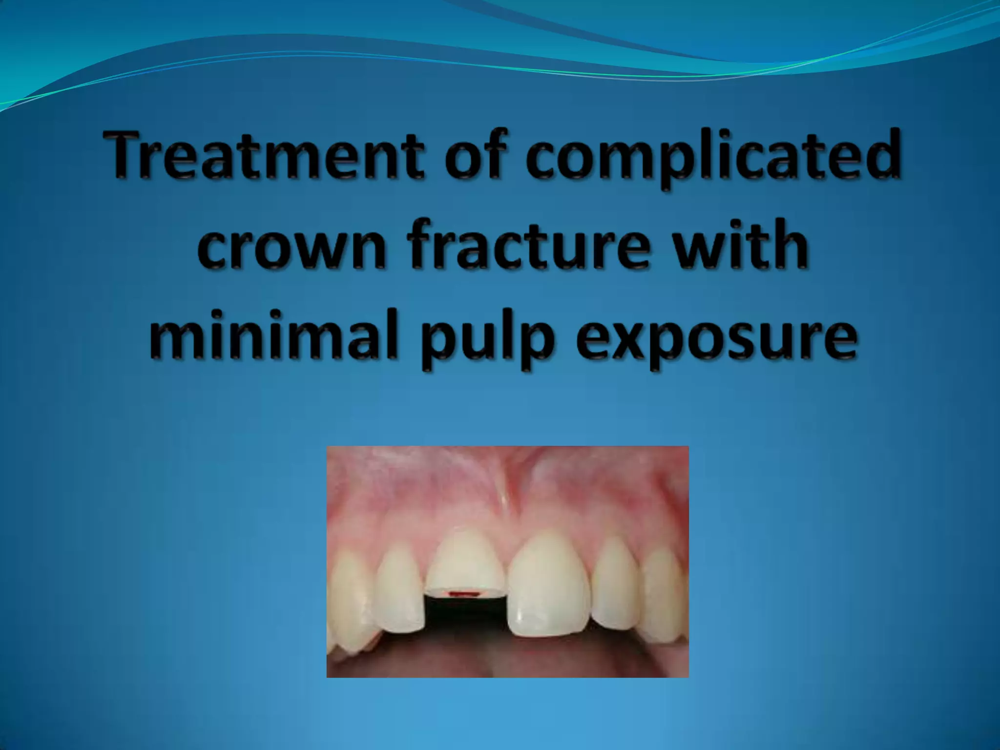 Treatment crown fracture | PPTX
