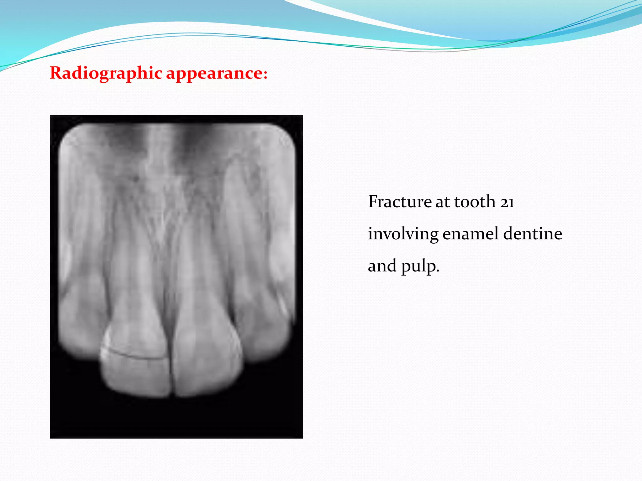 Treatment crown fracture | PPTX