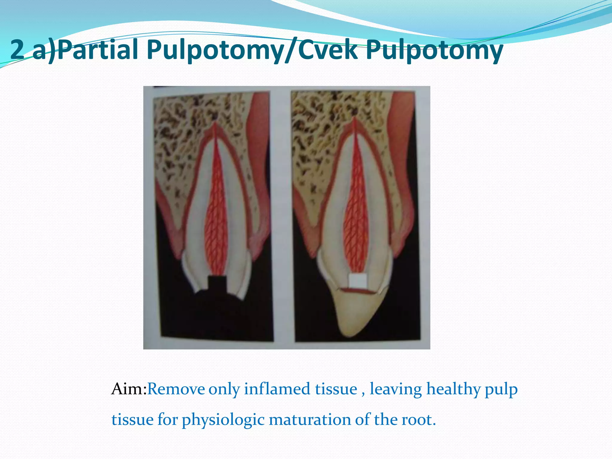 Treatment crown fracture | PPTX