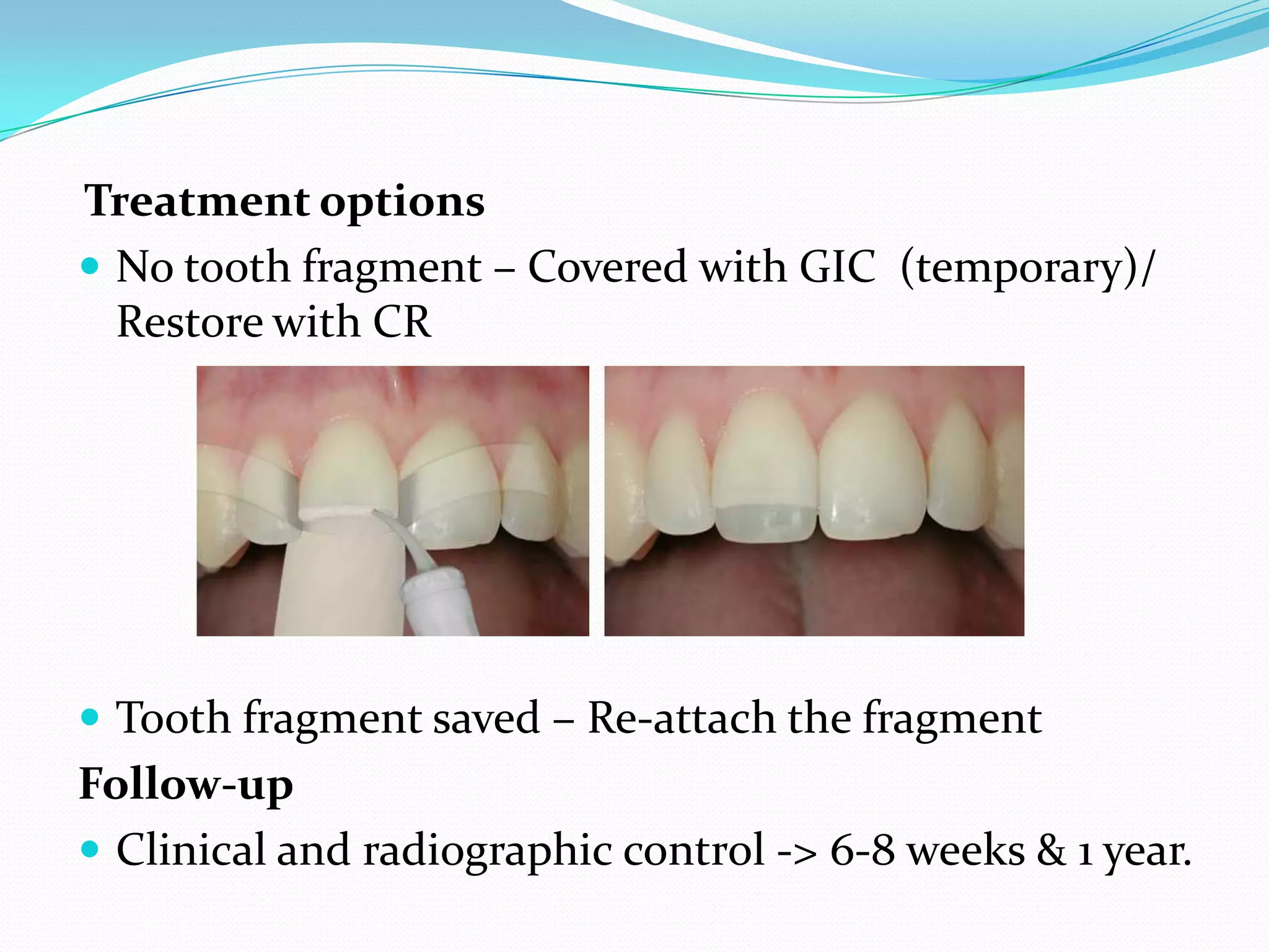Treatment crown fracture | PPTX