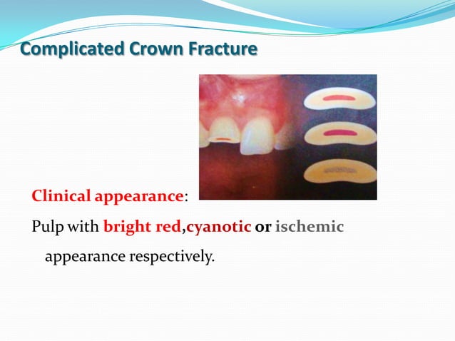 Treatment crown fracture | PPTX