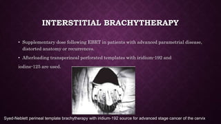 Treatment for Carcinoma Cervix | PPT