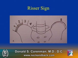 Treatment for scoliosis | curvature of the spine | thoracic kyphosis ...