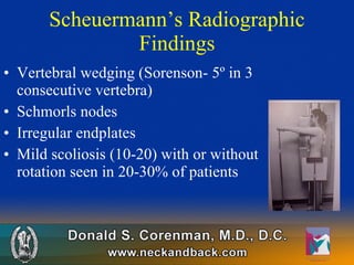 Treatment for scoliosis | curvature of the spine | thoracic kyphosis ...