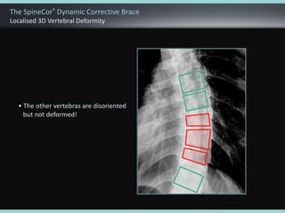 Treatment goal spine cor brace 5 01-2013 | PPT