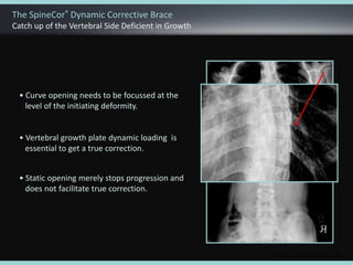 Treatment goal spine cor brace 5 01-2013 | PPT