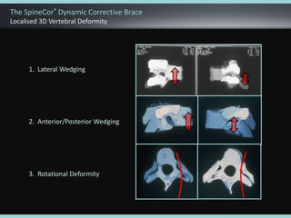 Treatment goal spine cor brace 5 01-2013 | PPT