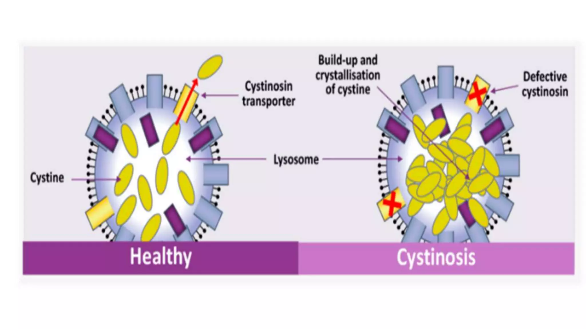 Treatment in cystinosis | PPT