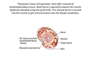 Treatment of lymphadenitis | PPT