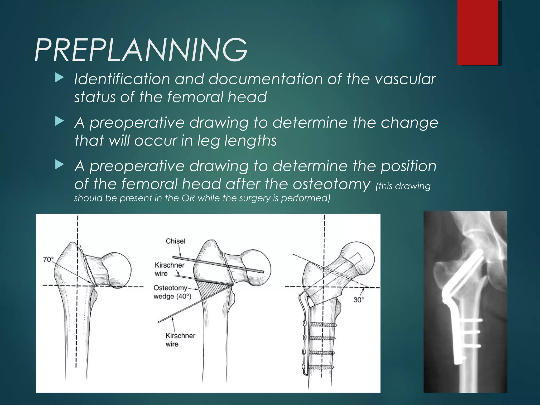 Treatment modality of non union fracture neck of femur | PPT