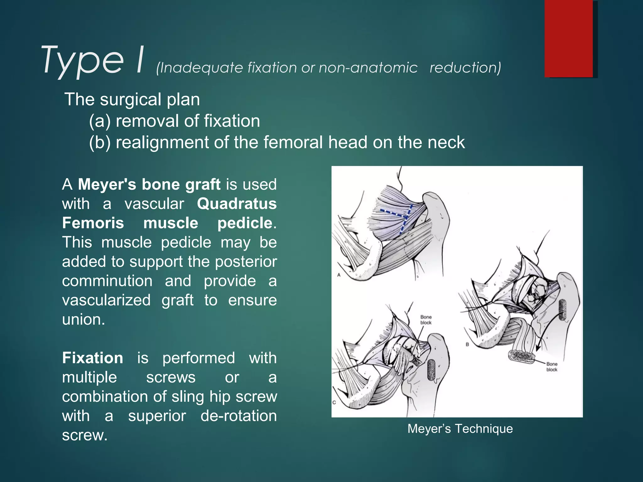 Treatment modality of non union fracture neck of femur | PPT