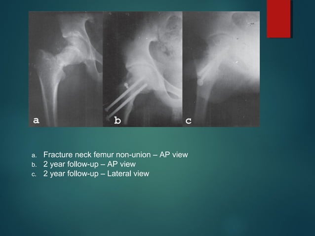 Treatment modality of non union fracture neck of femur | PPT
