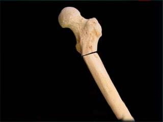 Treatment modality of non union fracture neck of femur | PPT