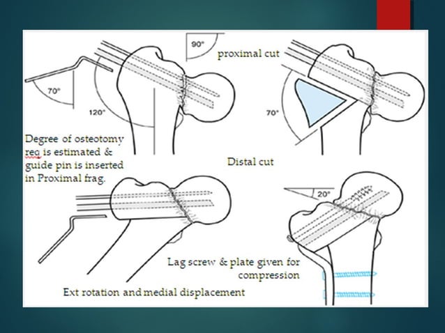 Treatment modality of non union fracture neck of femur | PPT